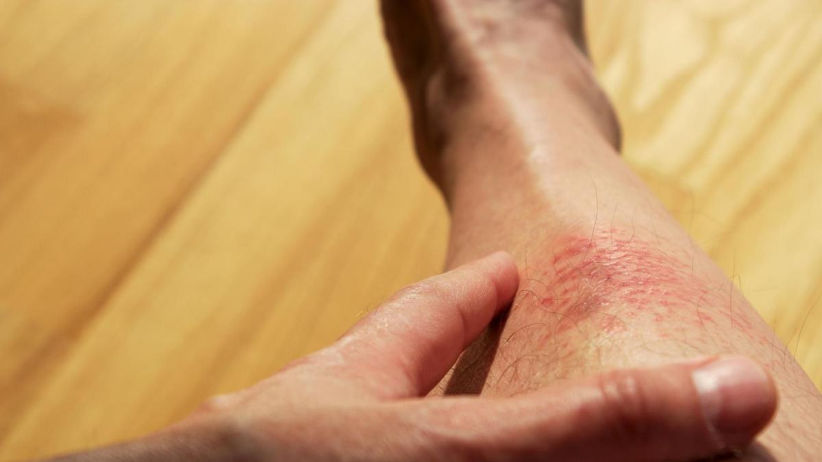 La alergia al sol ¿Qué es y cuáles son sus síntomas?